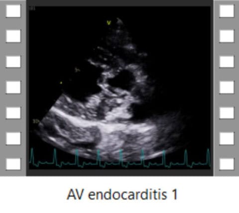 Infective Endocarditis of the aortic valve in a 7-year-old female ...