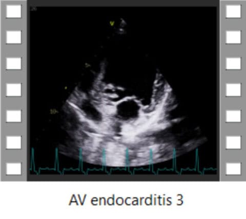 Infective Endocarditis of the aortic valve in a 7-year-old female ...